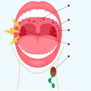 Strep Throat: Key Facts - West Plano Pediatrics